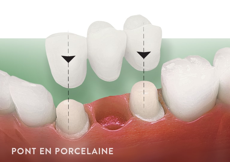 Pont dentaire │ Ponts dentaires en porcelaine